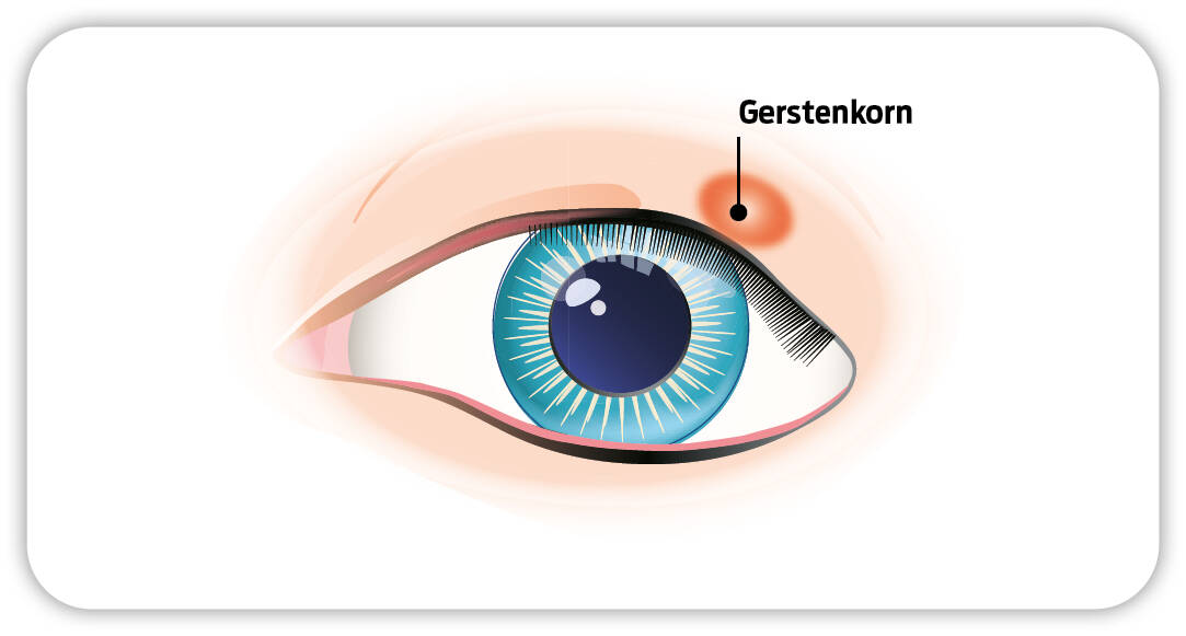 Gerstenkorn im Auge – alles was Sie wissen müssen | Similasan